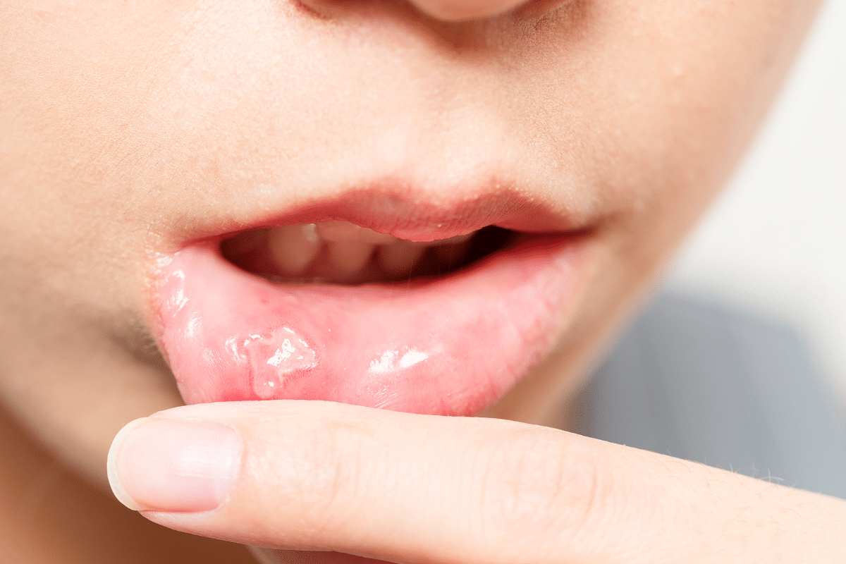 Baby Mouth Ulcers: Causes, Treatment, and When to See a Pediatric Dentist